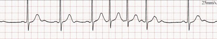 Ectopic Heartbeat Treatment In London, UK - Dr Boon Lim