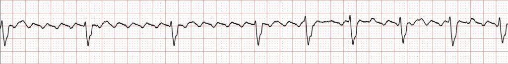 Atrial Flutter Treatment in London, UK | AF Causes | Dr Boon Lim