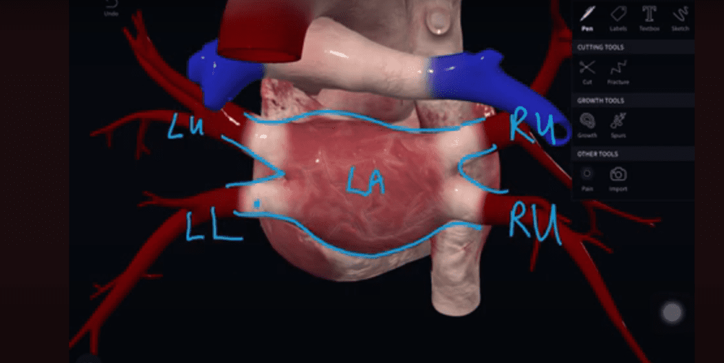 Atrial Fib Ablation - Cryoablation Focus - Top London Cardiologist